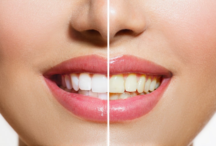 How Can I Improve the Appearance of a Single Stained Tooth?